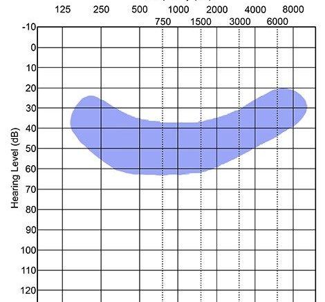 What is Audiogram?